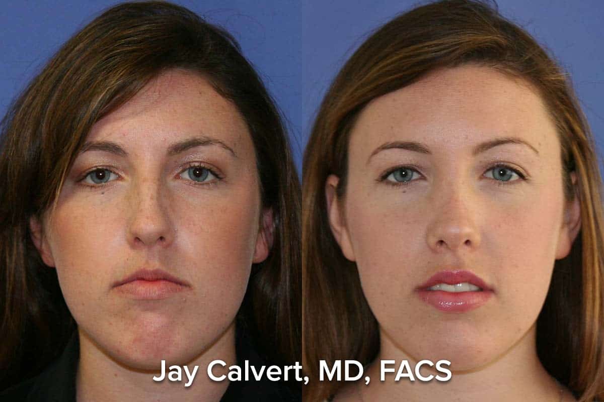 Plastic Surgery Before & After - Dr Jay Calvert