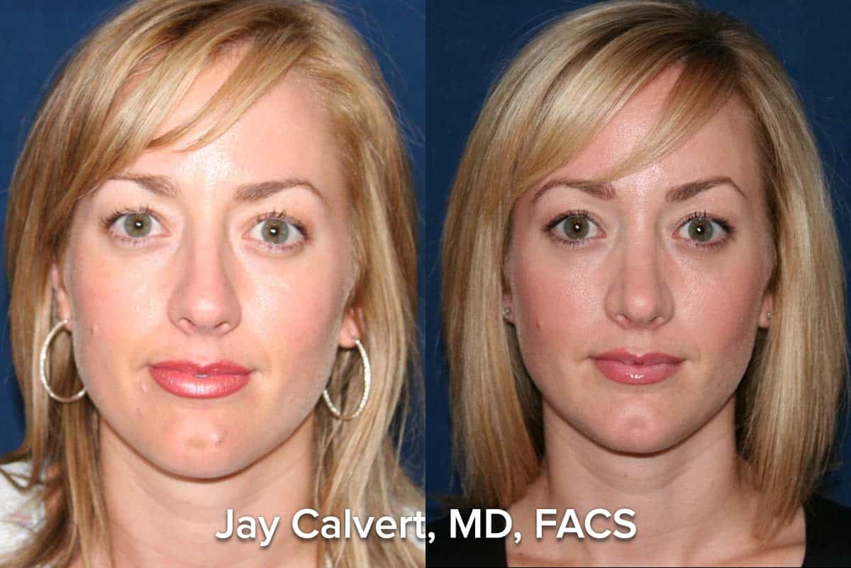 Plastic Surgery Before & After - Dr Jay Calvert