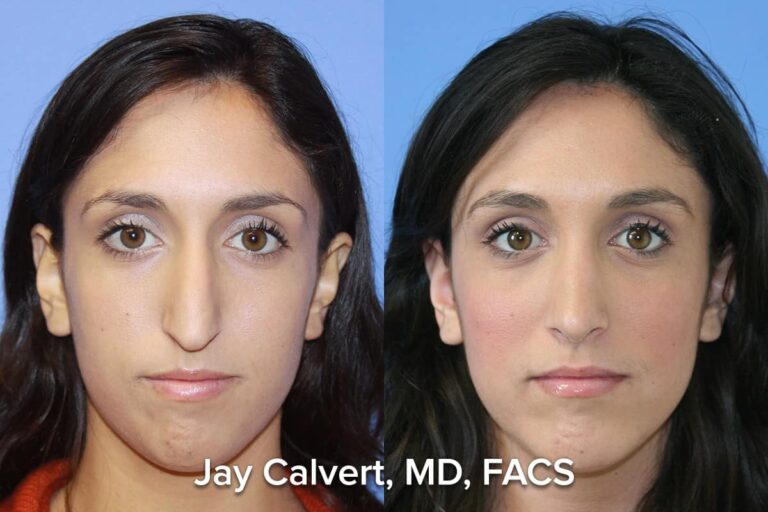 Plastic Surgery Before & After - Dr Jay Calvert