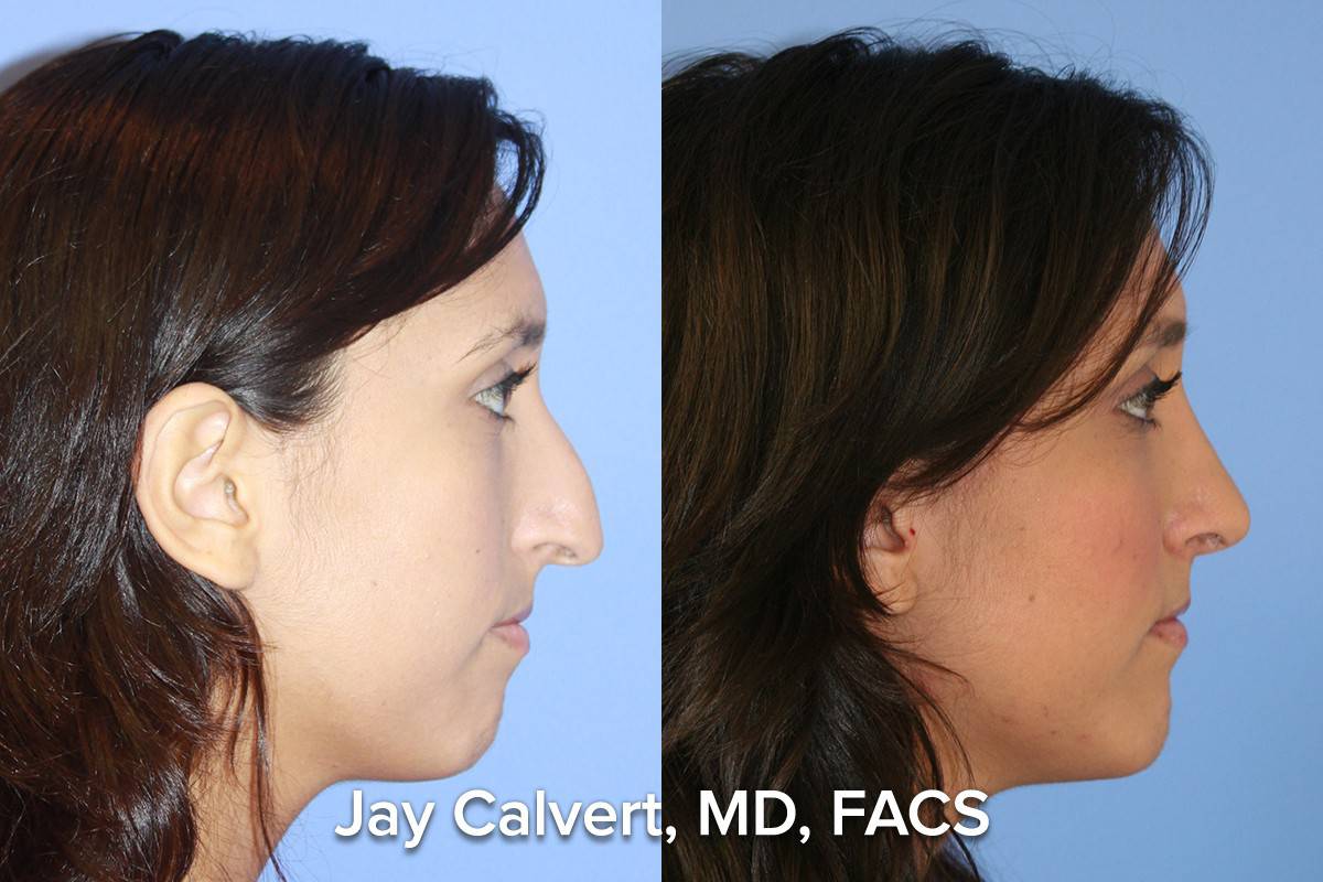 Face Implants Before and After - Dr Jay Calvert