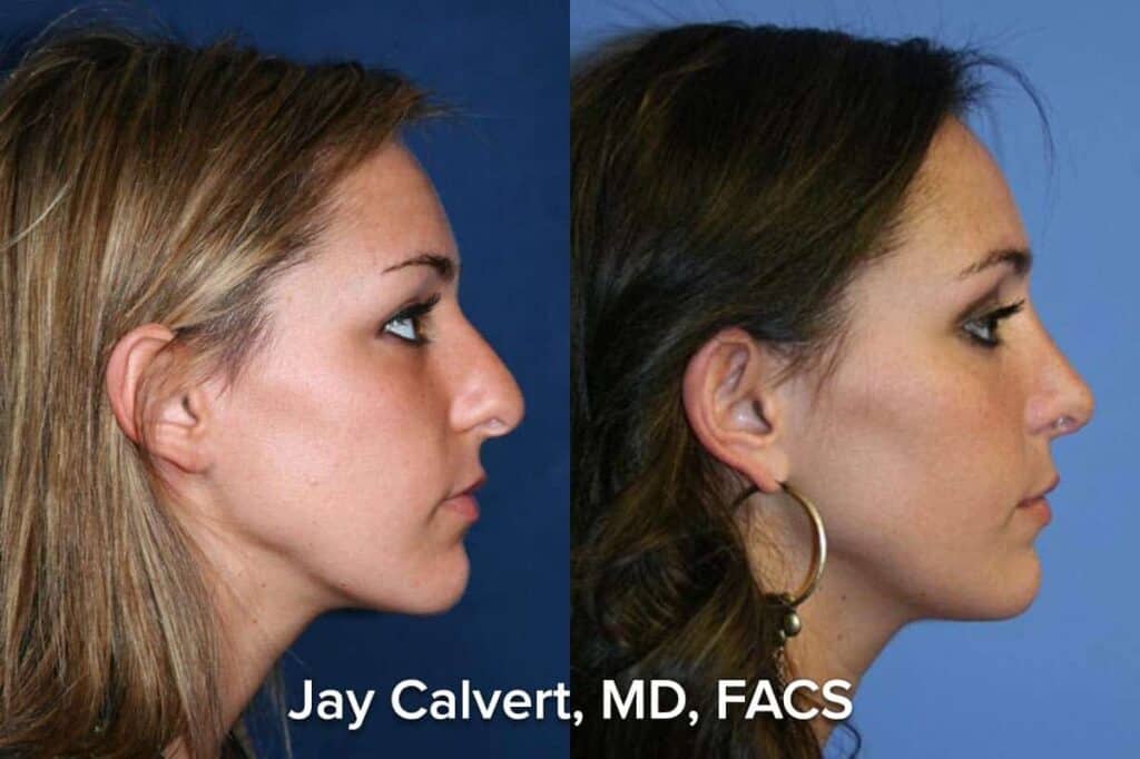 Rhinoplasty Beverly Hills - Best Nose Job - Dr. Jay Calvert