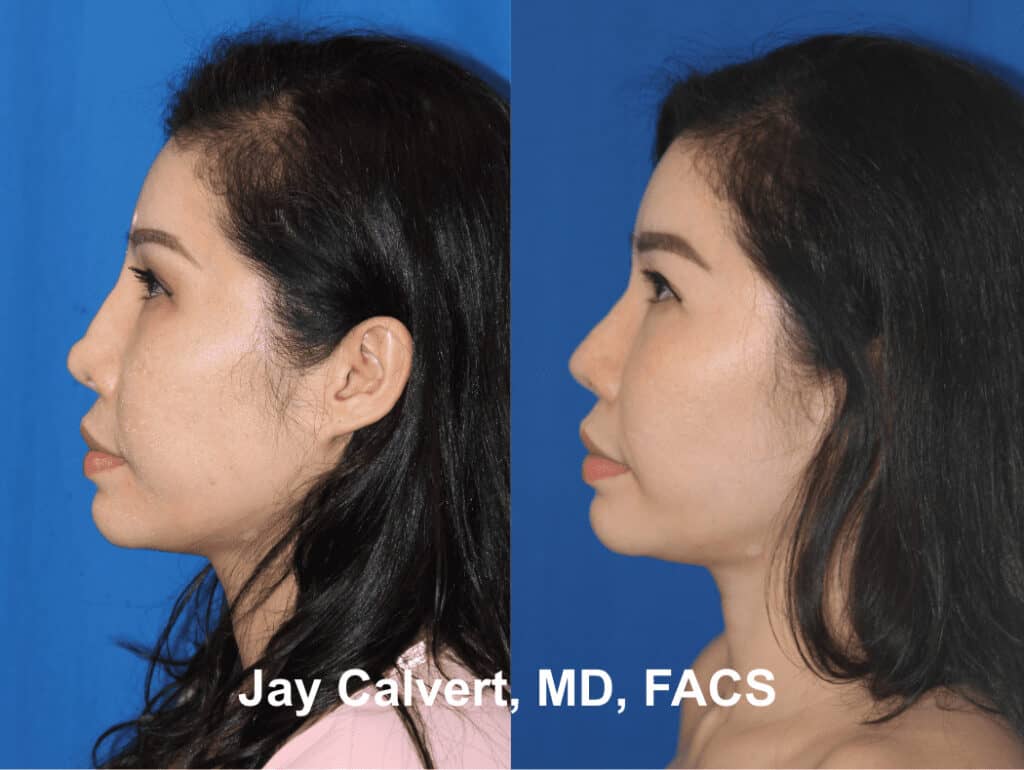 Rhinoplasty Beverly Hills - Best Nose Job - Dr. Jay Calvert