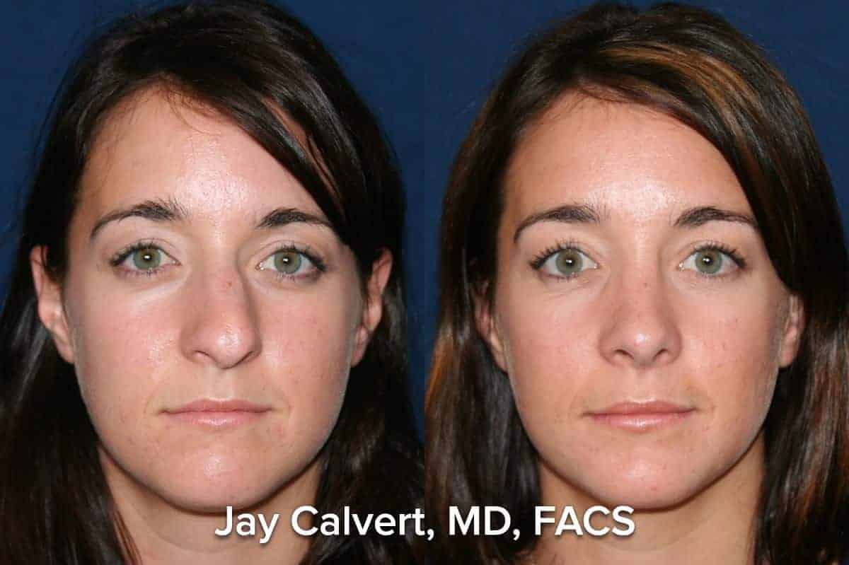Rib Graft Nasal Reconstruction