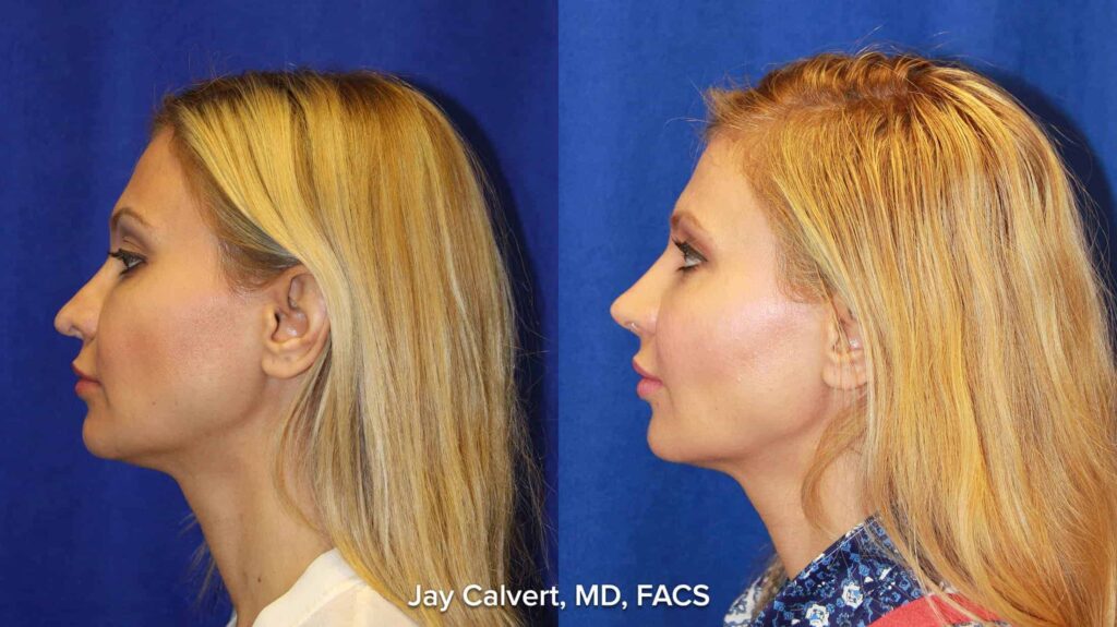 Rib Cartilage Rhinoplasty - Rib Cartilage Rhinoplasty