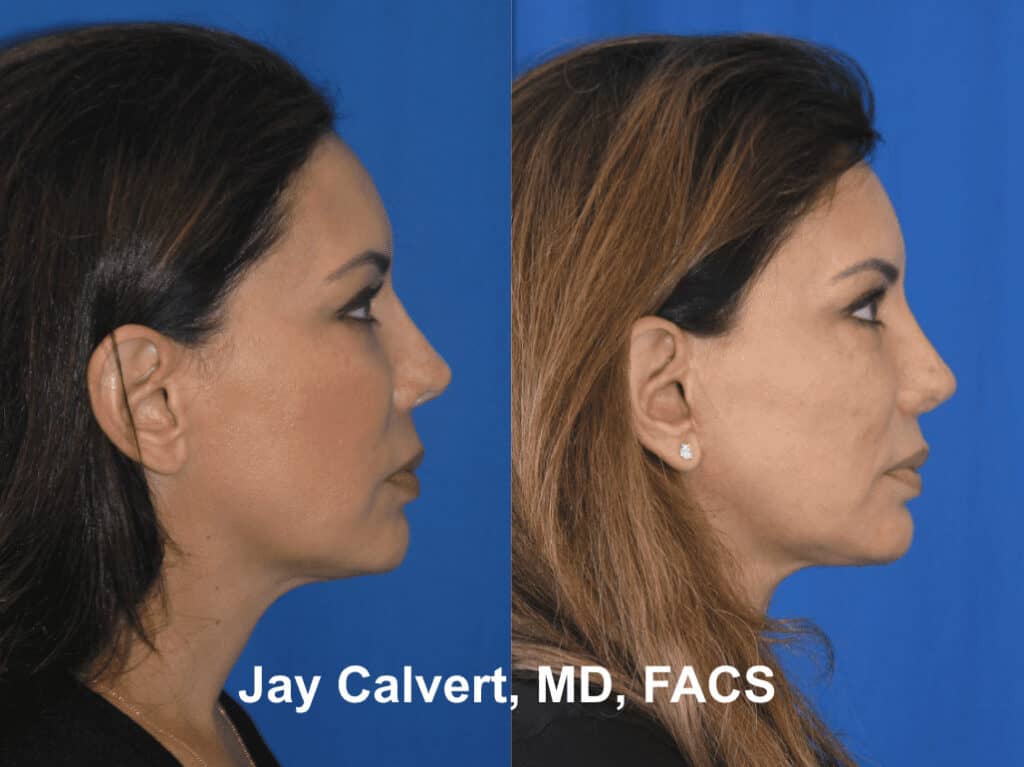 Revision Rhinoplasty Beverly Hills - Revision Rhinoplasty Specialist