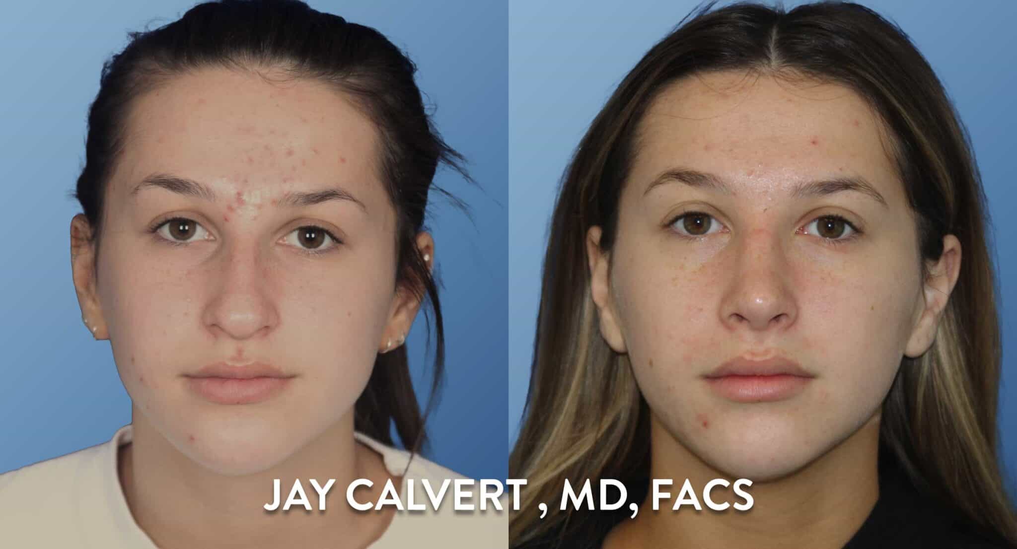Rhinoplasty Before and After Beverly Hills - Dr Jay Calvert