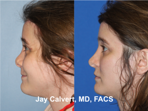 Before And After Transgender Rhinoplasty - Dr. Jay Calvert