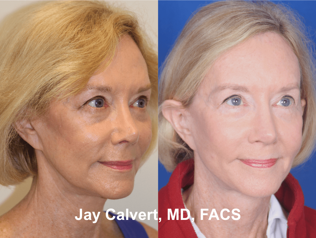 Facelift Before and After - Beverly Hills - Dr Jay Calvert