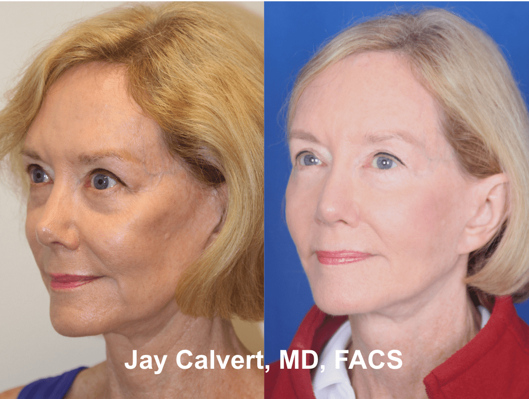 Facelift Before and After - Beverly Hills - Dr Jay Calvert
