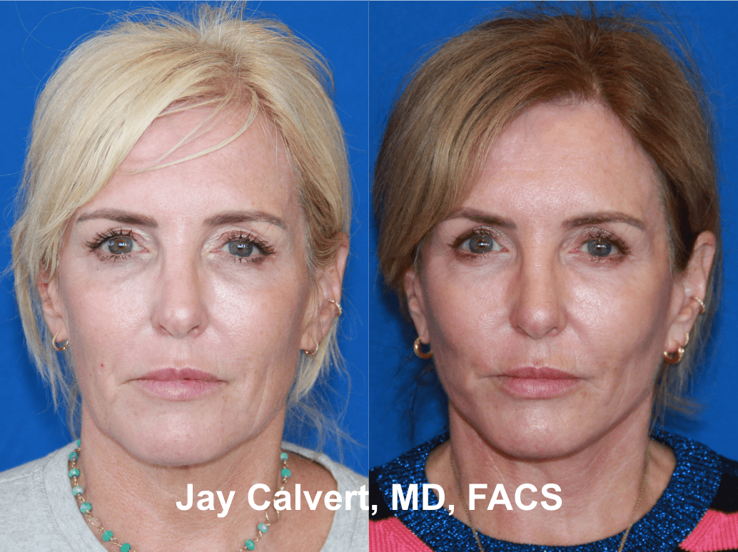 Facelift Before and After - Beverly Hills - Dr Jay Calvert