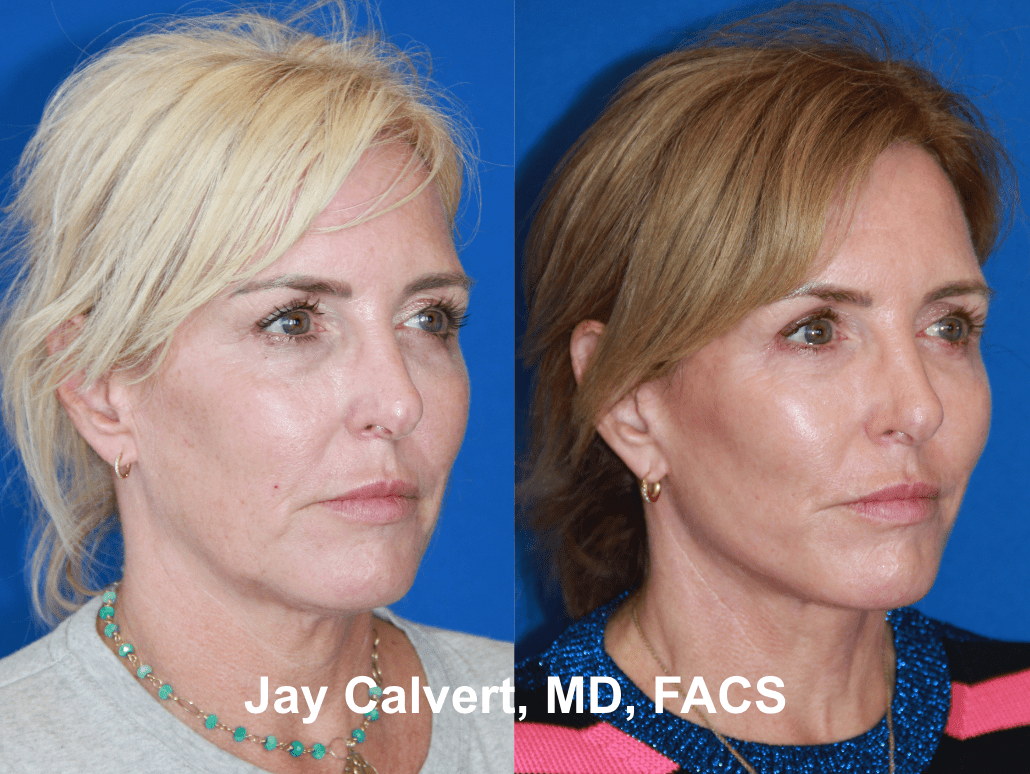 Facelift Before and After - Beverly Hills - Dr Jay Calvert