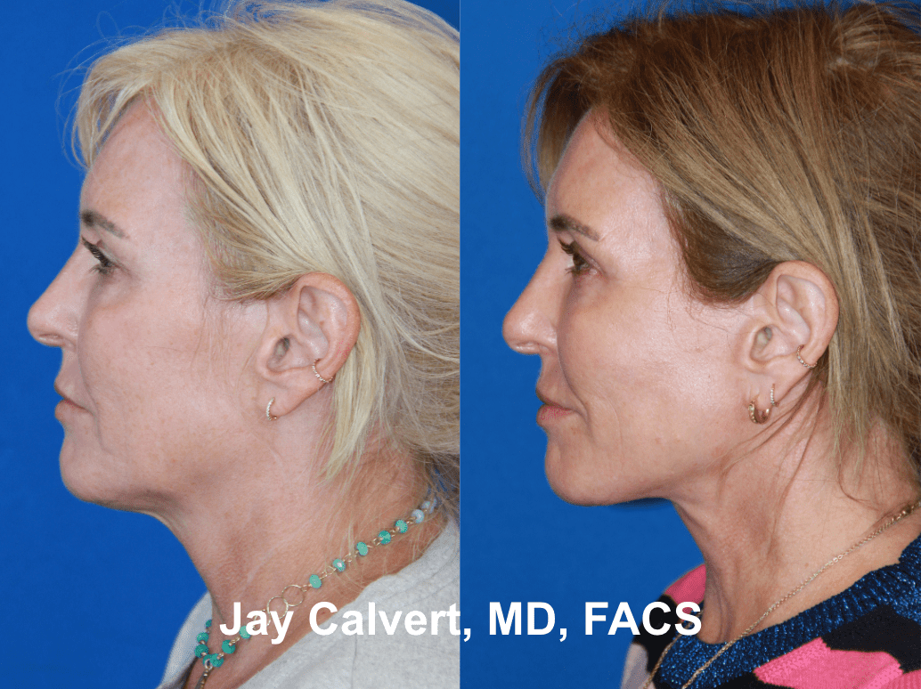 Facelift Before and After - Beverly Hills - Dr Jay Calvert