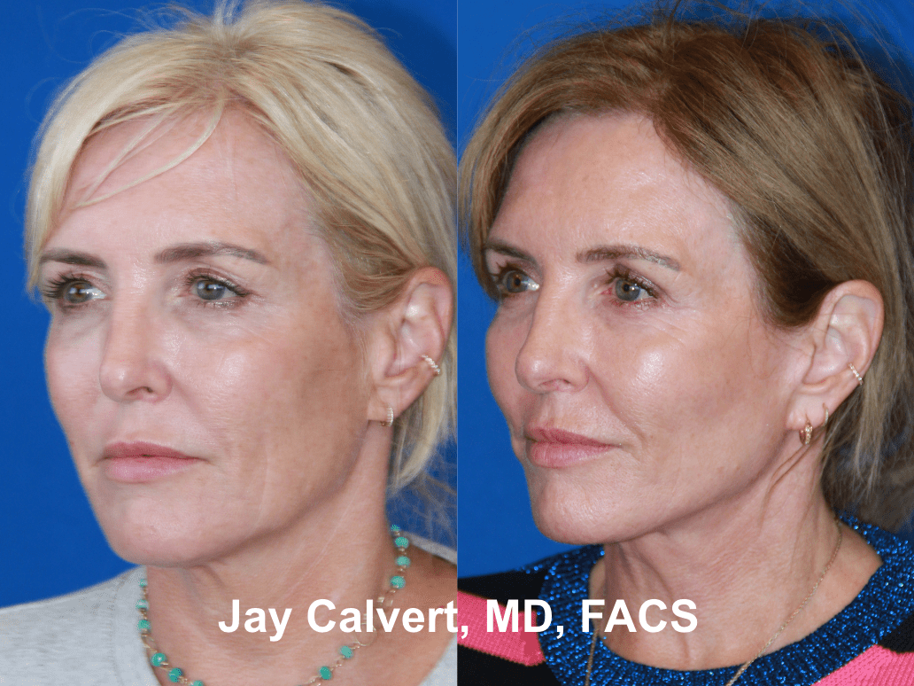 Facelift Before and After - Beverly Hills - Dr Jay Calvert