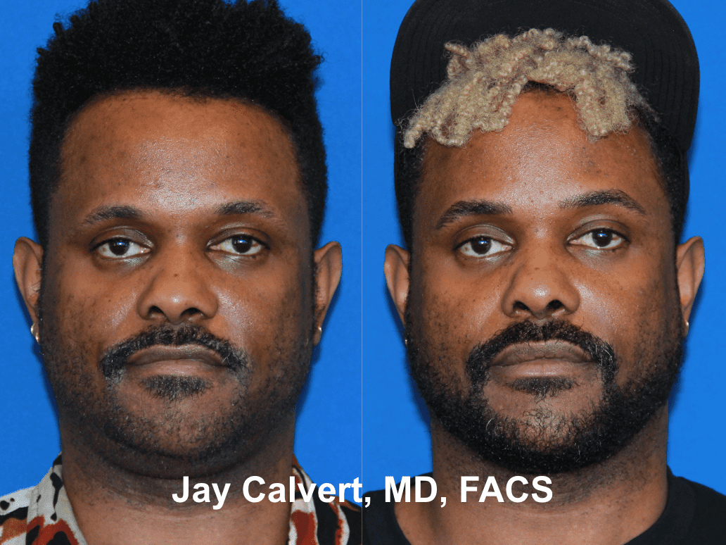 Face Implants Before and After - Dr Jay Calvert