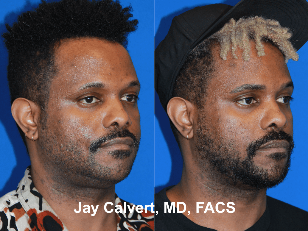 Face Implants Before and After - Dr Jay Calvert