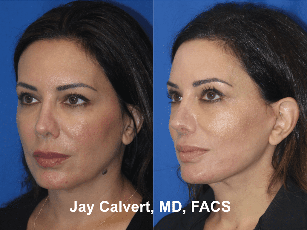 Facelift Before and After - Beverly Hills - Dr Jay Calvert