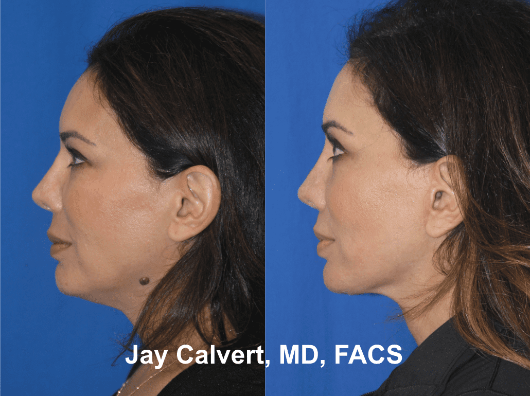 Facelift Before and After - Beverly Hills - Dr Jay Calvert
