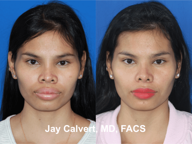 Plastic Surgery Before & After - Dr Jay Calvert