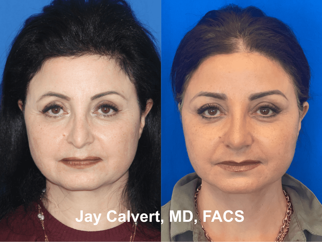 Facelift Before and After - Beverly Hills - Dr Jay Calvert