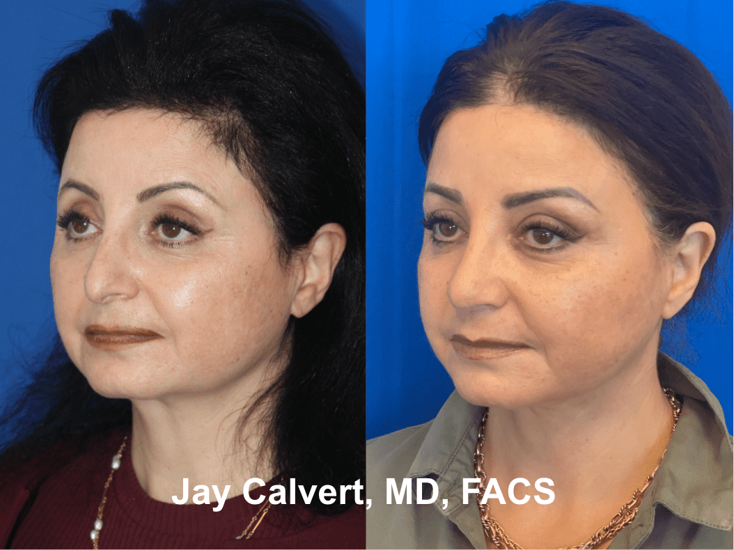 Facelift Before and After - Beverly Hills - Dr Jay Calvert