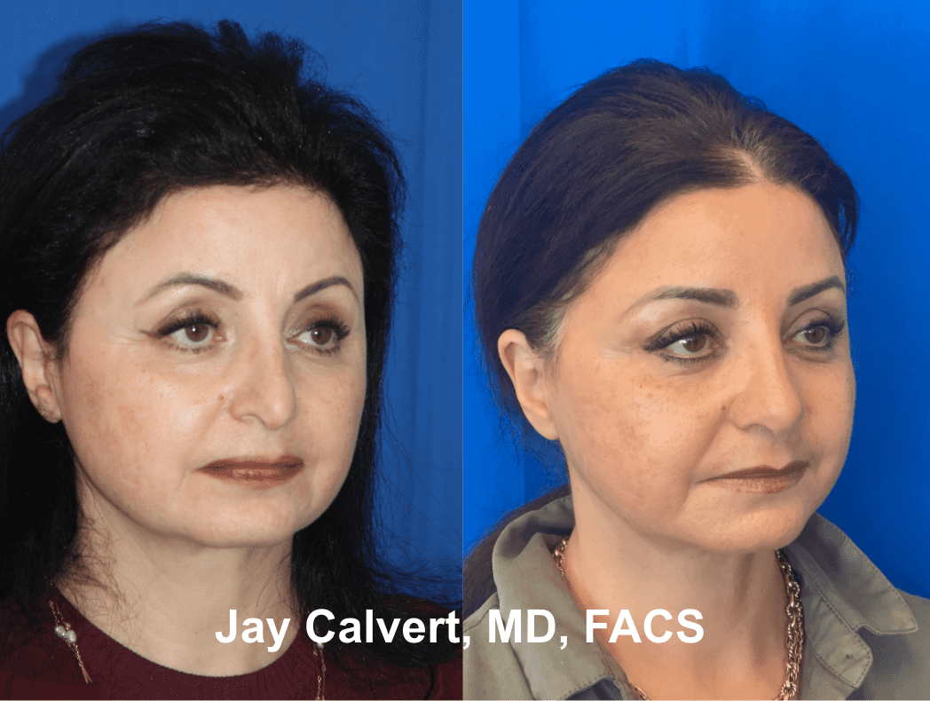 Facelift Before and After - Beverly Hills - Dr Jay Calvert