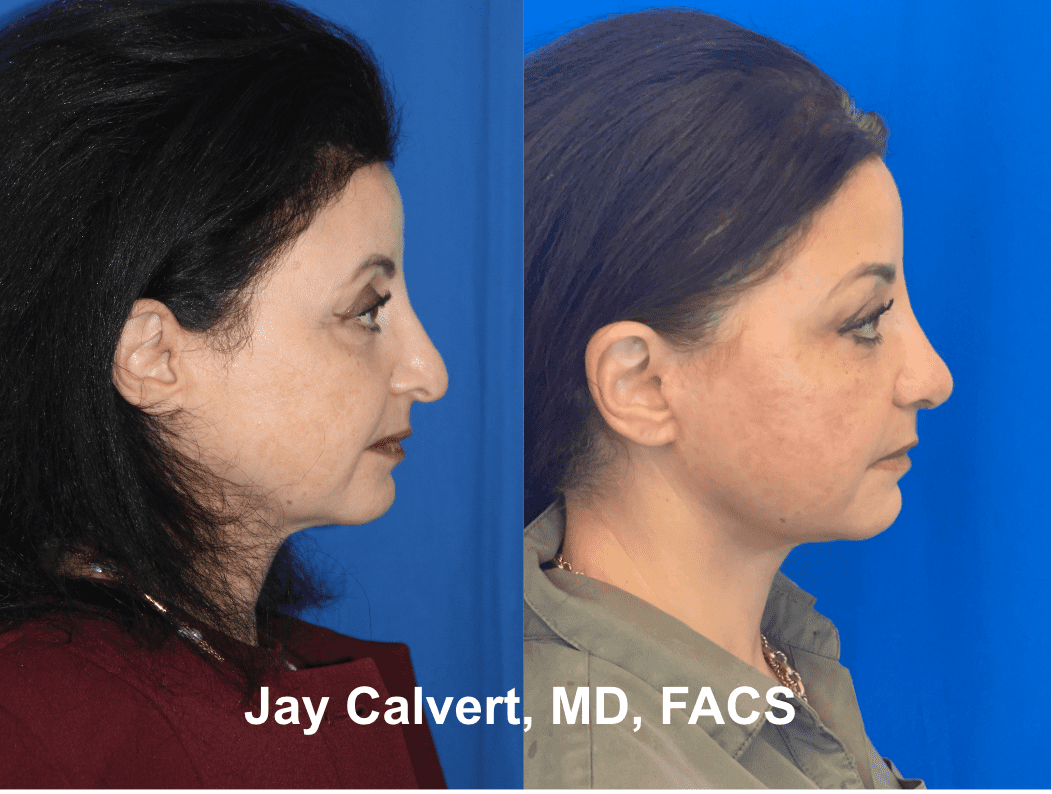 Facelift Before and After - Beverly Hills - Dr Jay Calvert