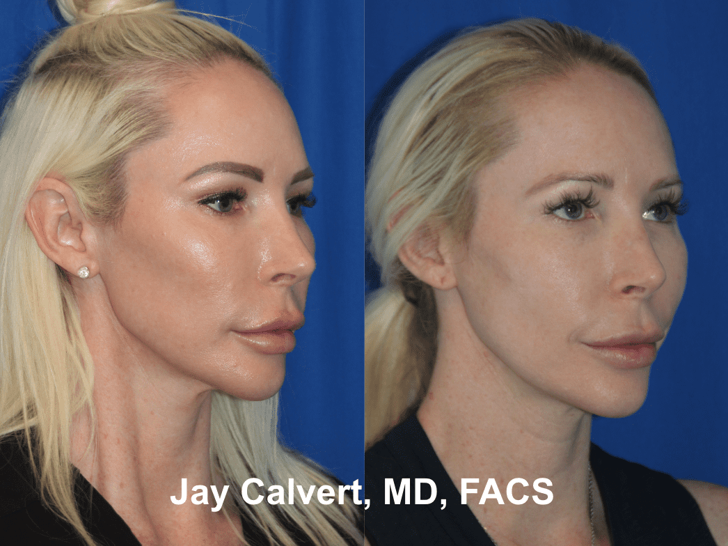 Facelift Before and After - Beverly Hills - Dr Jay Calvert