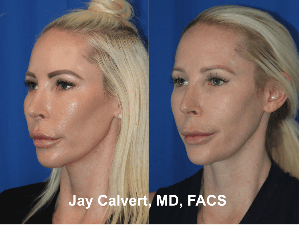 Facelift Before and After - Beverly Hills - Dr Jay Calvert