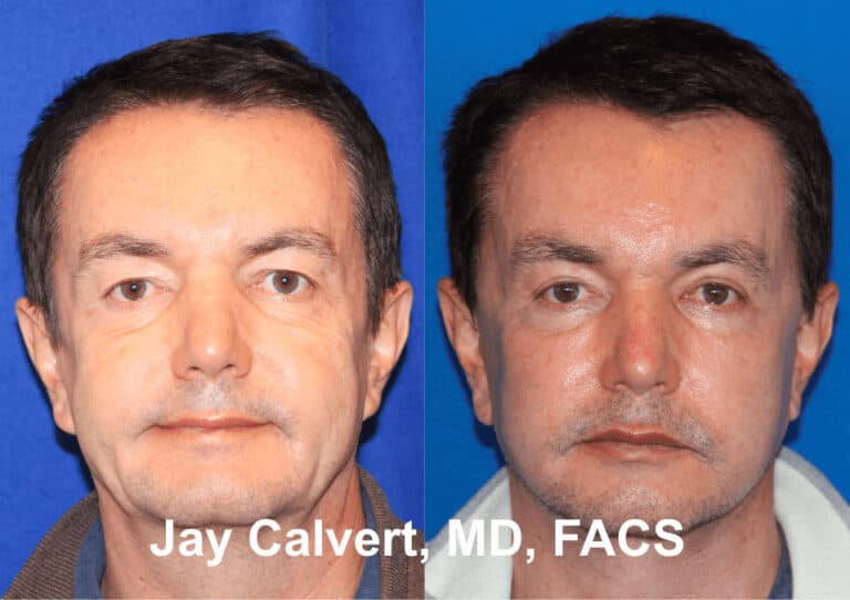 The Natural Lift by Dr. Jay Calvert
