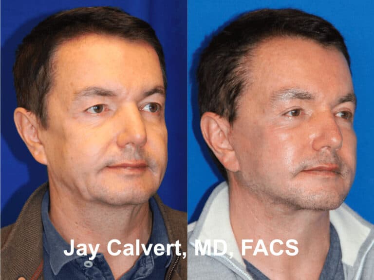 The Natural Lift by Dr. Jay Calvert