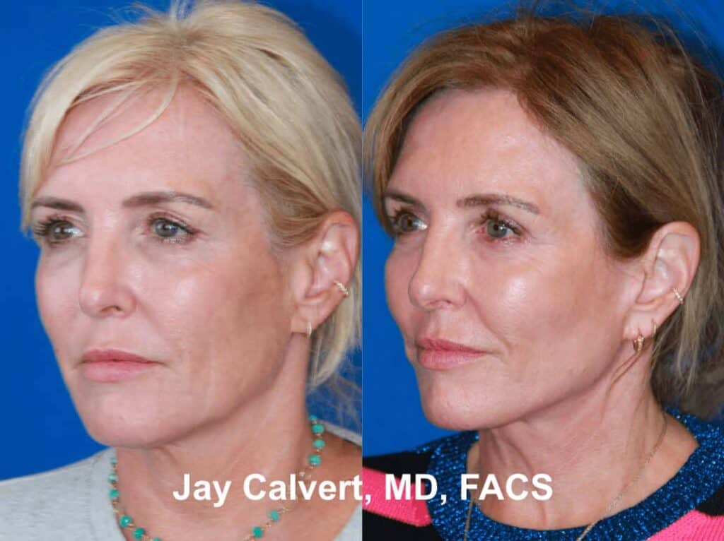 Deep Plane Facelift Beverly Hills - Deep Plane Facelift Surgery