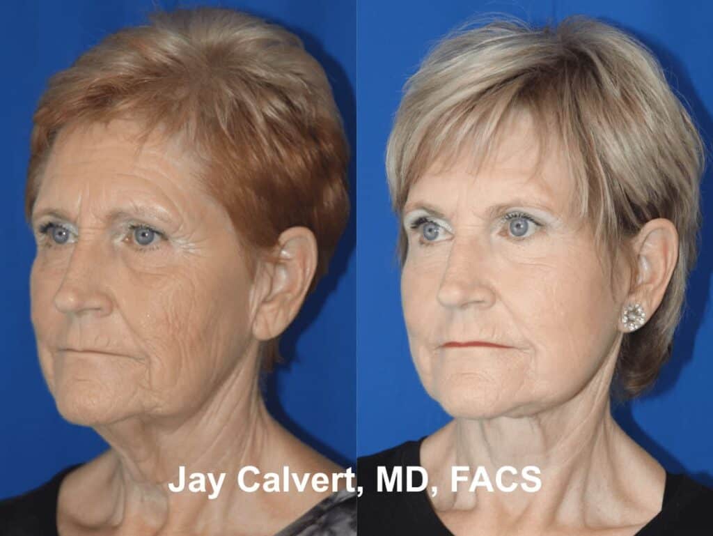 Deep Plane Facelift Beverly Hills - Deep Plane Facelift Surgery