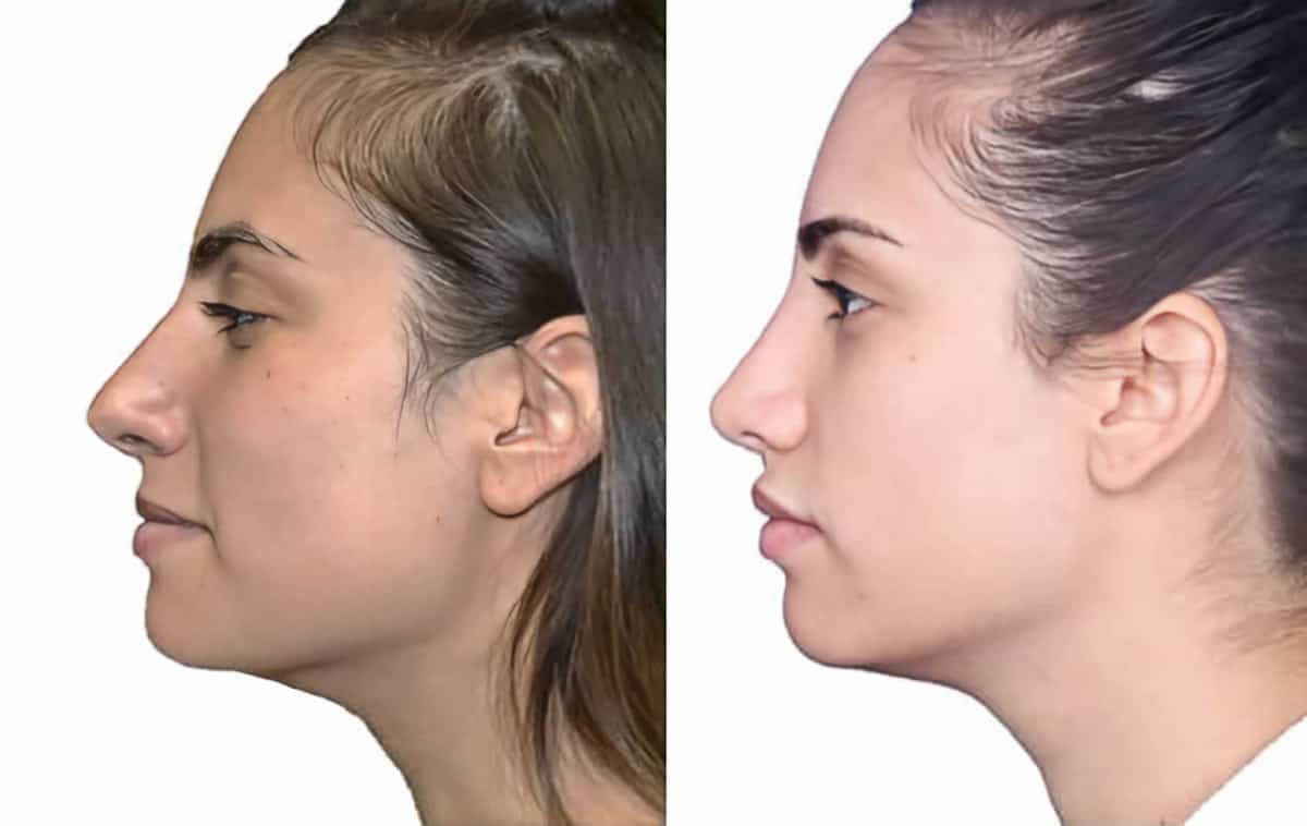 Rhinoplasty Beverly Hills - Best Nose Job - Dr. Jay Calvert