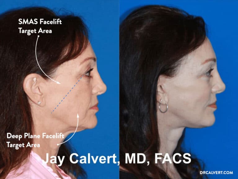 Deep Plane Facelift Beverly Hills - Deep Plane Facelift Surgery