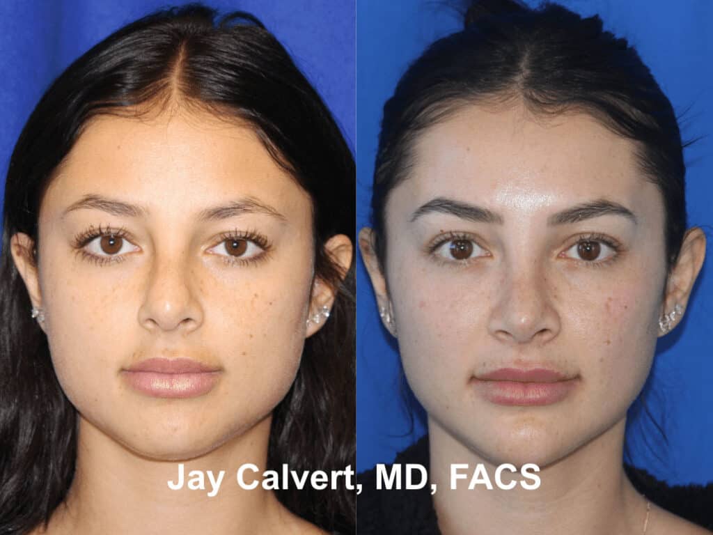 Best Rhinoplasty Surgeon in America - Dr. Jay Calvert