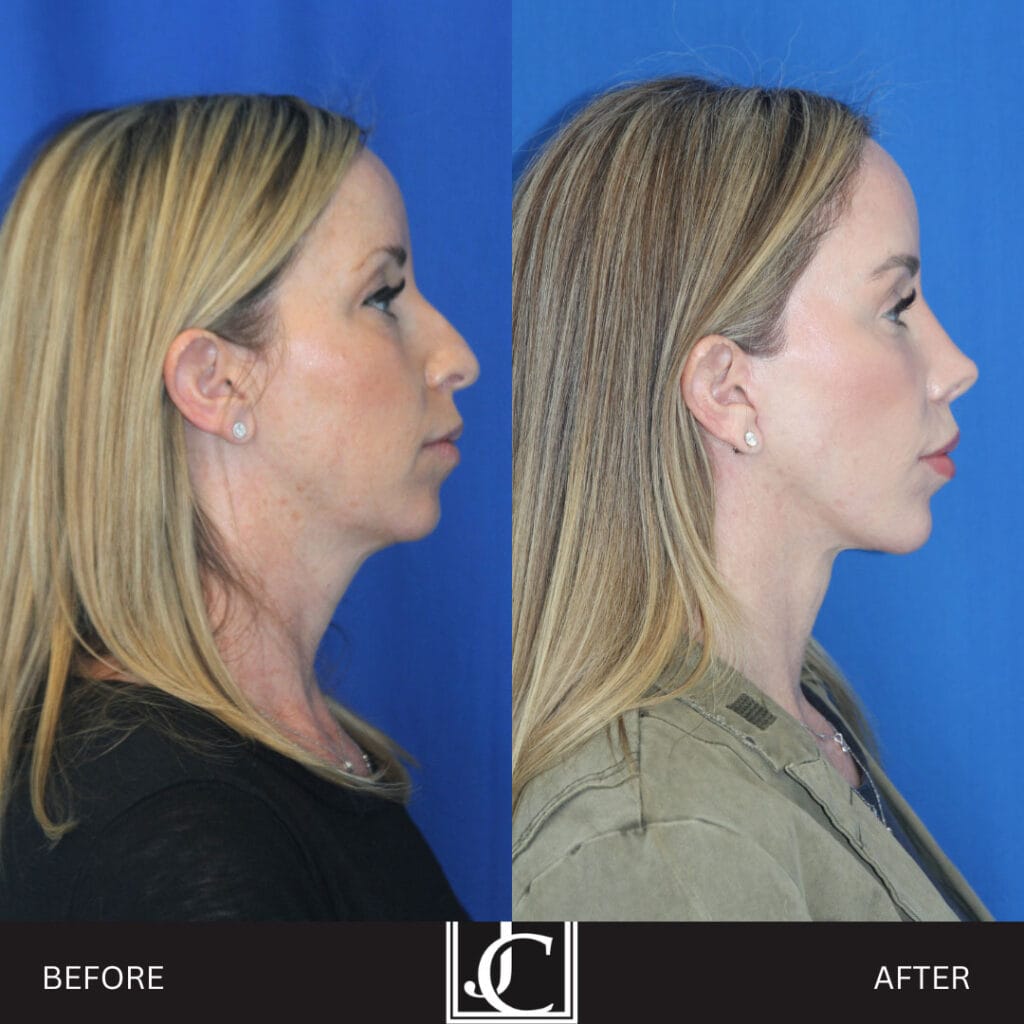Before And After Midface Lift Before and After - Dr. Jay Calvert