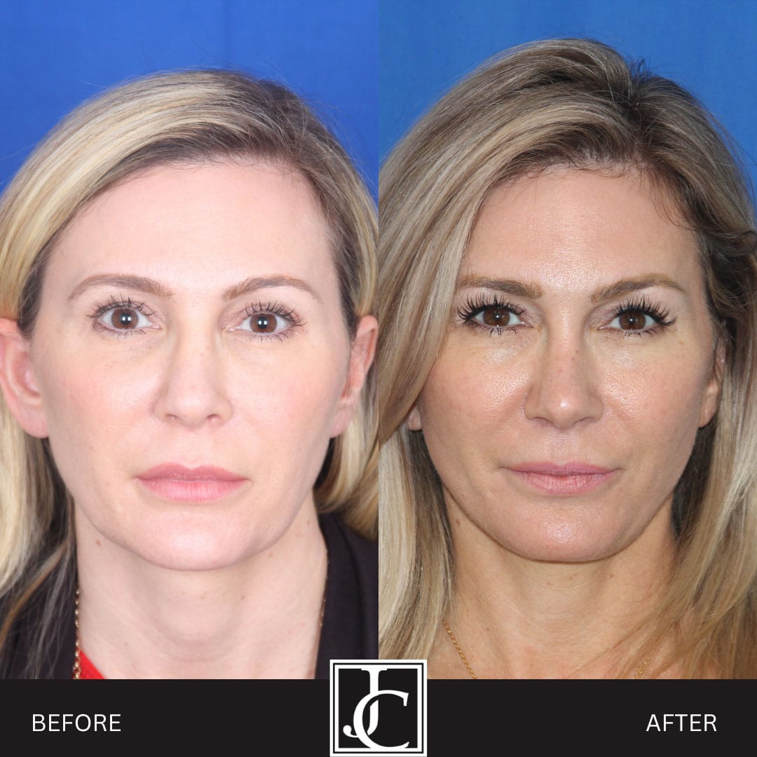 Secondary Rhinoplasty with RIB Graft - Dr Jay Calvert