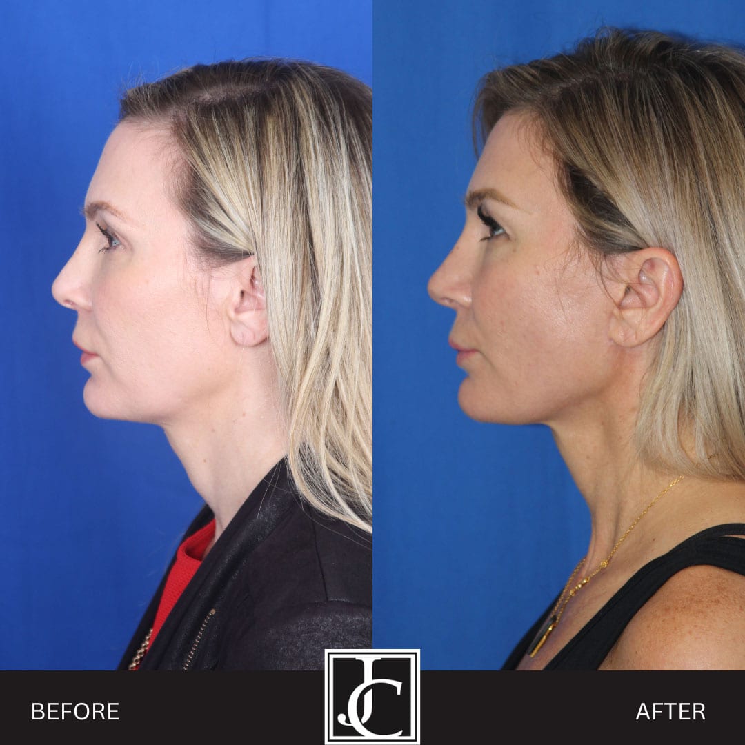 Secondary Rhinoplasty with RIB Graft - Dr Jay Calvert