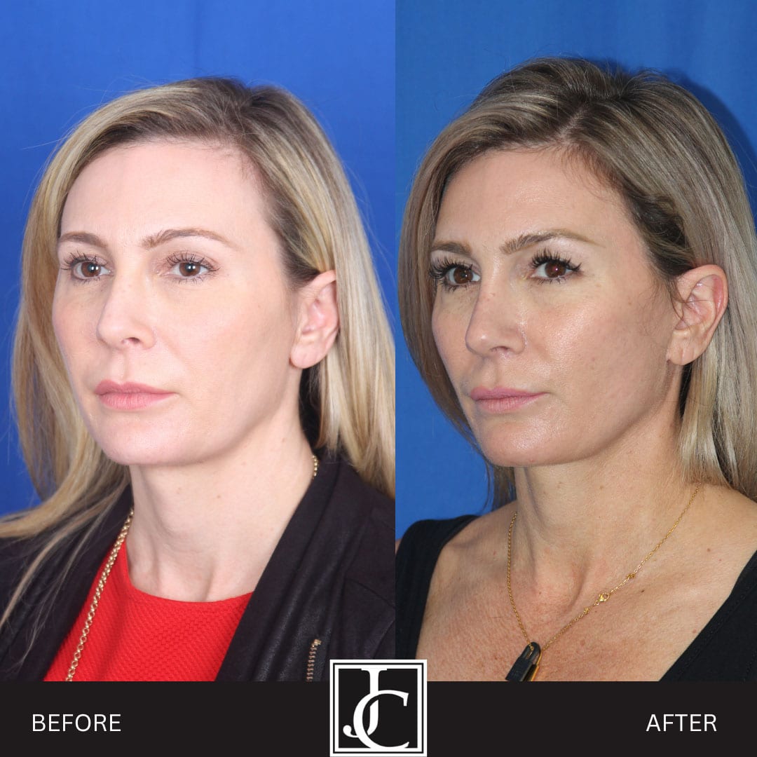 Secondary Rhinoplasty with RIB Graft - Dr Jay Calvert