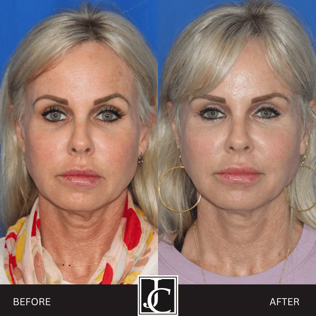 Before And After Midface Lift Before and After - Dr. Jay Calvert