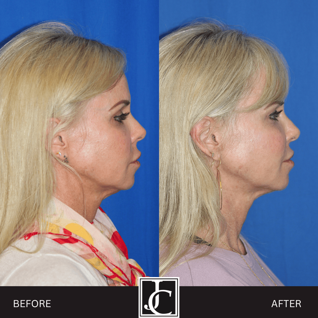 Before And After Midface Lift Before and After - Dr. Jay Calvert