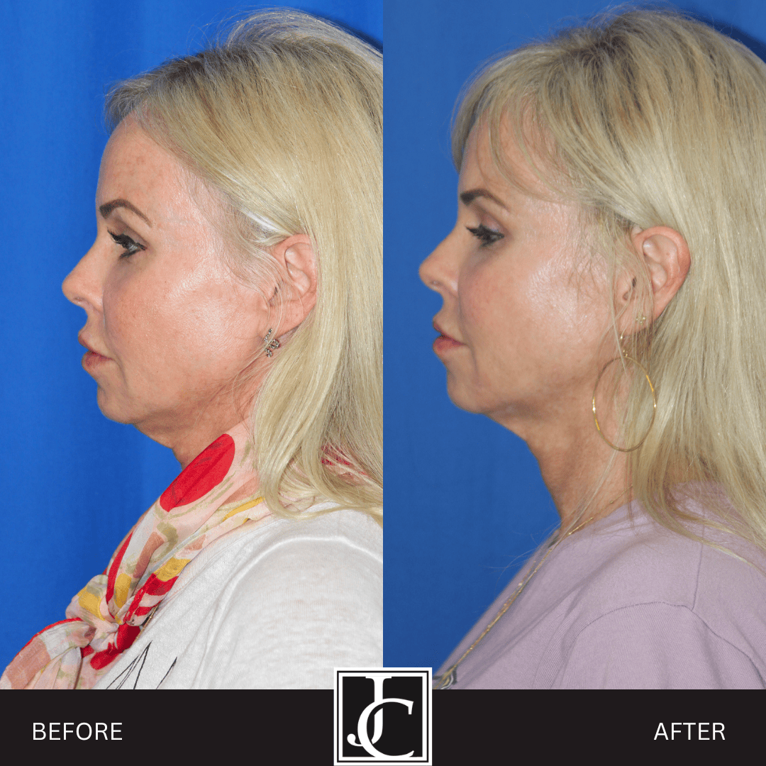 Before And After Midface Lift Before and After - Dr. Jay Calvert