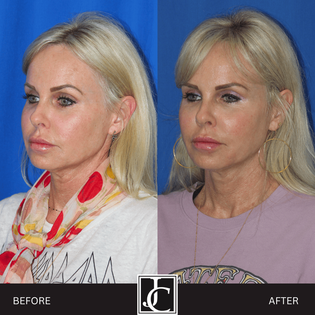 Before And After Midface Lift Before and After - Dr. Jay Calvert