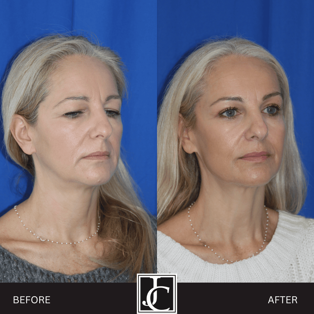 Before And After Midface Lift Before and After - Dr. Jay Calvert