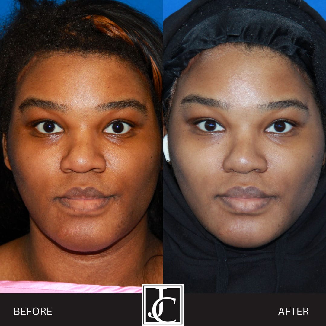 Before And After Facial Feminization - Dr. Jay Calvert