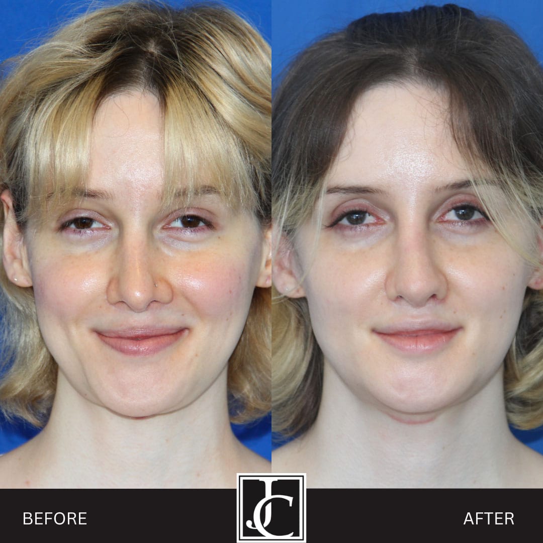 Before And After Transgender Rhinoplasty - Dr. Jay Calvert