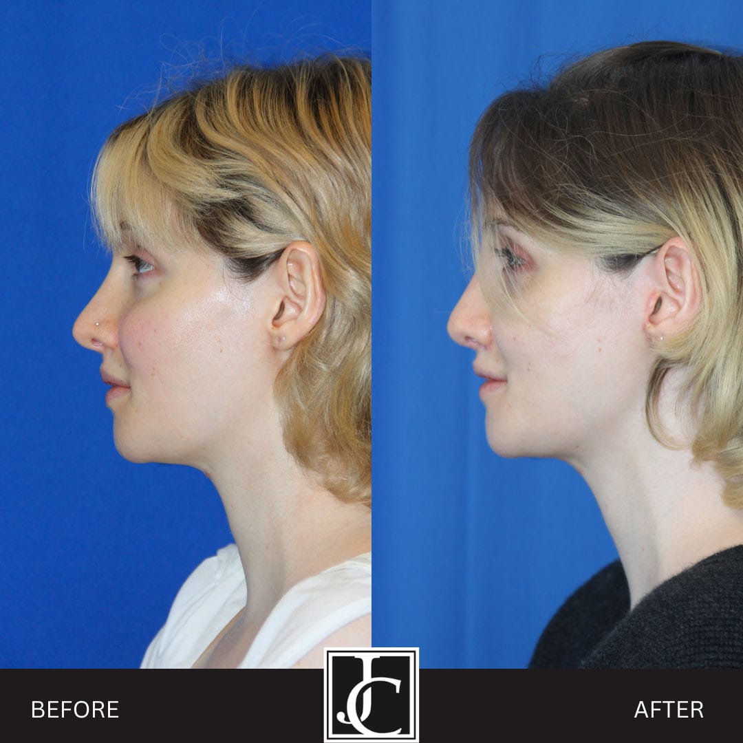 Before And After Transgender Rhinoplasty - Dr. Jay Calvert